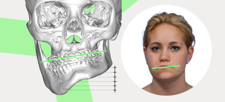 Asymmetrical Jaw & Chin: Causes and How to Fix it Naturally | Mewing.coach Asymmetrical Jaw & Chin: Causes and How to Fix it Naturally | Mewing.coach