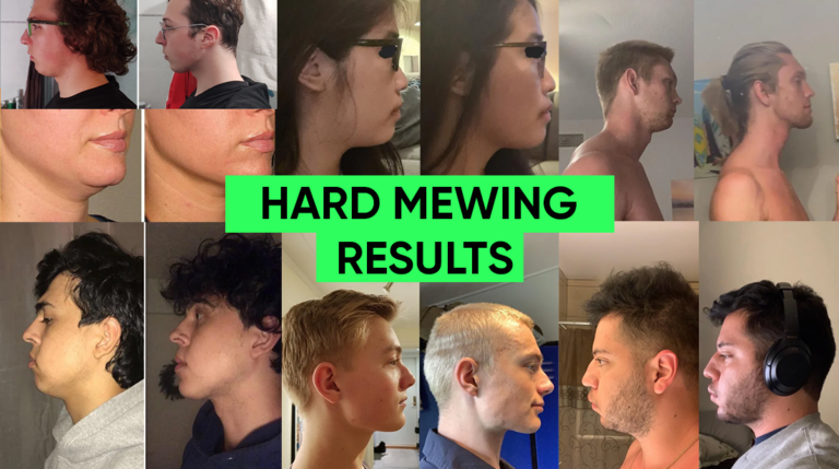 What Is Hard Mewing and How to Make Sure You're Ready for It | Mewing.coach