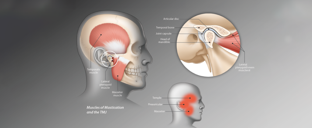 How to Treat TMJ Disorder With Mewing: Is it Possible | Mewing.coach