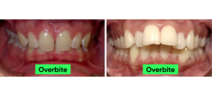 How Can Mewing Fix Overbite | Mewing.coach