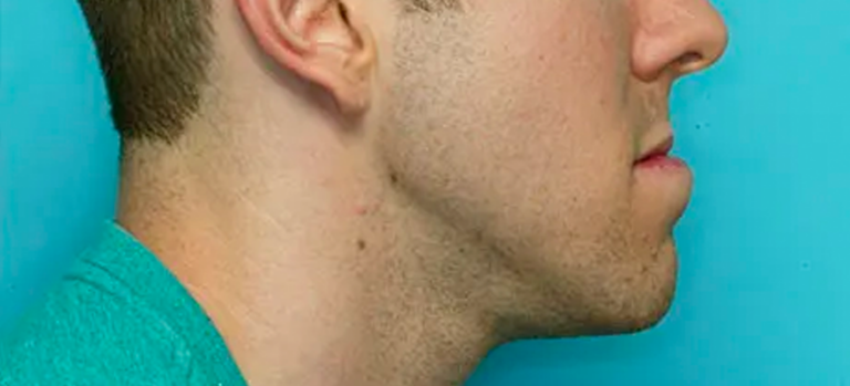 How Can Mewing Fix Underbite | Mewing.coach