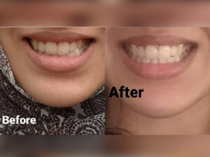 How Mewing Helps You Sculpt Your Jawline? Expert Advises | Mewing.coach