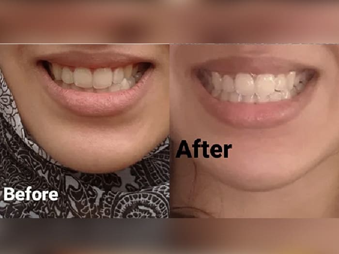 How Mewing Helps You Sculpt Your Jawline Expert Advises Mewing coach