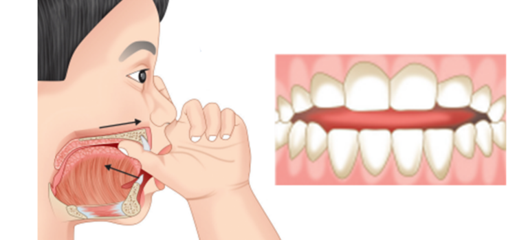 Long Face Syndrome: Symptoms and How to Fix Mouth Breathing Face ...