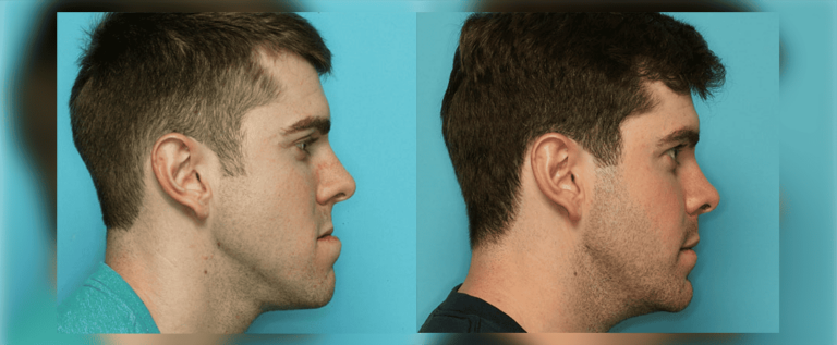 How to Get a Better Jawline: Exercises and Tips | Mewing.coach
