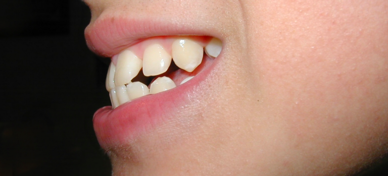 How To Fix Underbite Naturally At Home (6 Effective Solutions) | Mewing ...