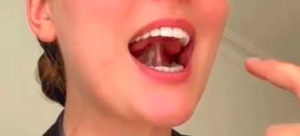 How Can Mewing Fix Underbite | Mewing.coach