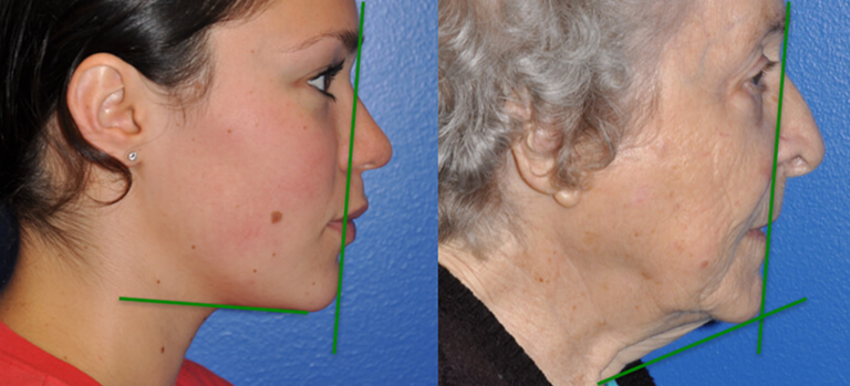 What Is a Double Chin Smile, and How to Get Rid of It | Mewing.coach