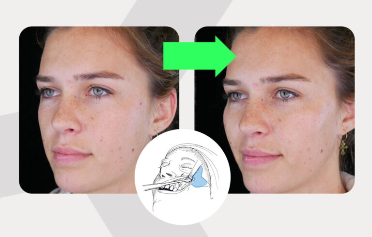 Find Out How to Get Hollow Cheeks: 16 Different Ways | Mewing.coach