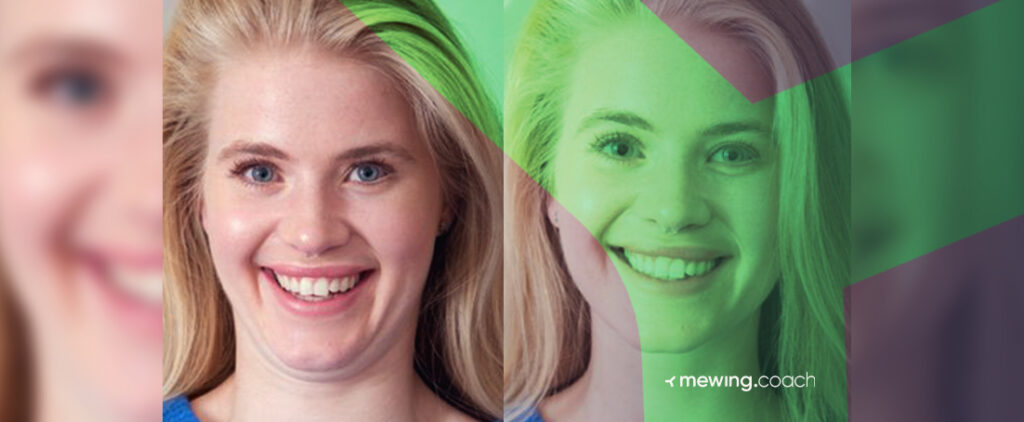 Double Chin While Skinny: Causes and How to Get Rid of It | Mewing.coach