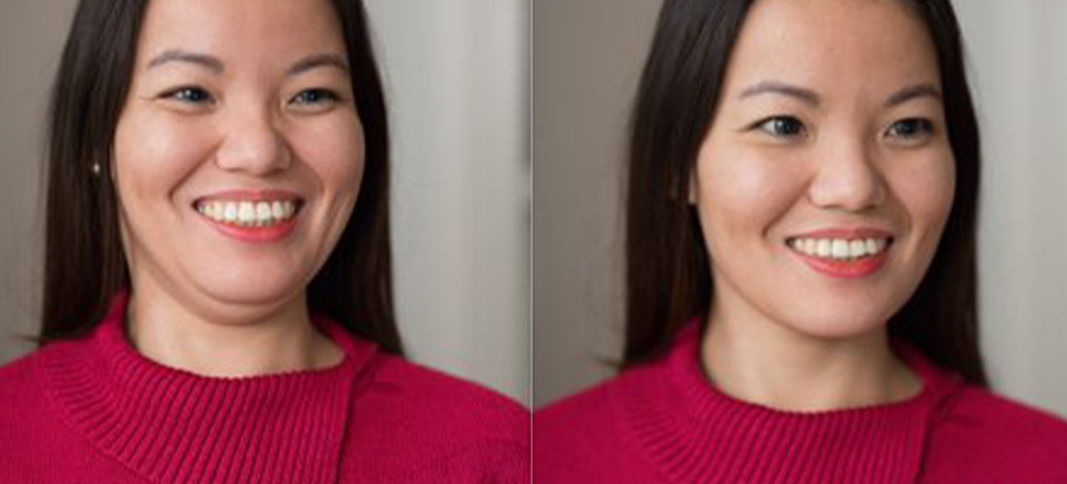 What Is a Double Chin Smile, and How to Get Rid of It | Mewing.coach