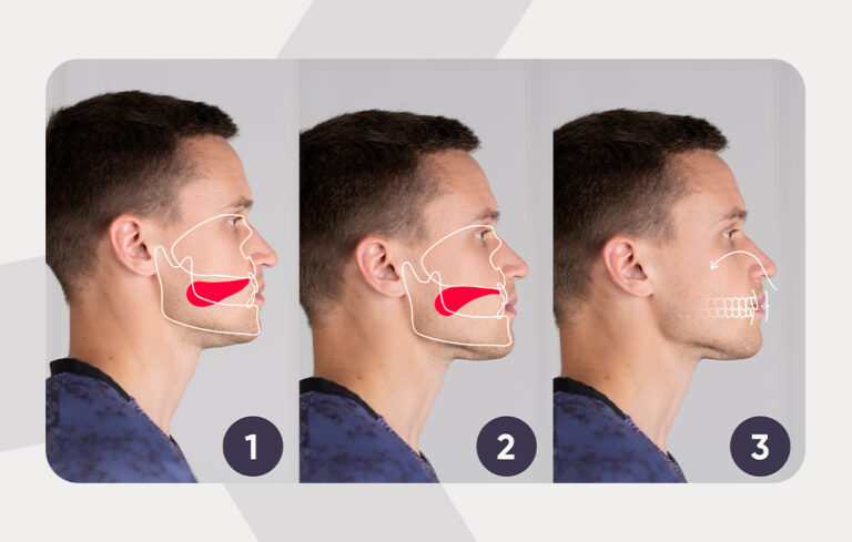 Double Chin While Skinny: Causes and How to Get Rid of It | Mewing.coach