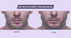 How to Get Rid of a Pointy Chin if It’s Too Visible to Your Liking ...