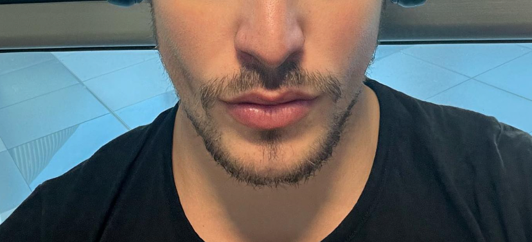 10 Different Types & Shapes of Chin: A Comprehensive List | Mewing.coach