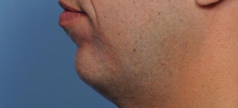 10 Different Types & Shapes of Chin: A Comprehensive List | Mewing.coach