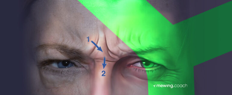 How To Get Rid of Glabellar Lines: 10 Methods | Mewing.coach