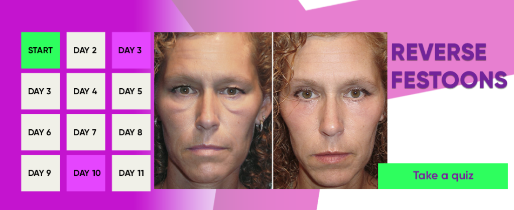 11 Tips on How to Treat Festoons Without Surgery | Mewing.coach