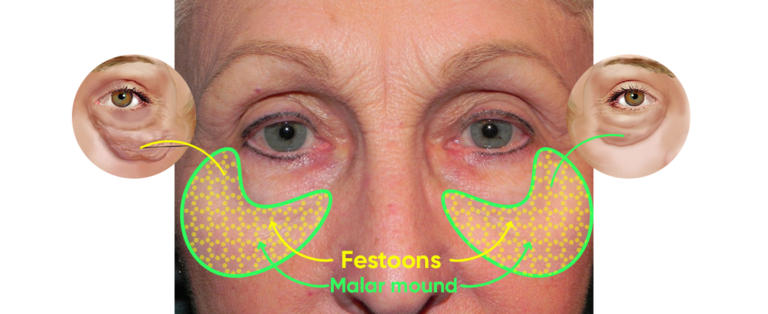 11 Tips on How to Treat Festoons Without Surgery | Mewing.coach