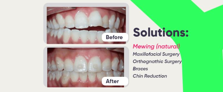 Long Face Syndrome: Symptoms and How to Fix Mouth Breathing Face ...