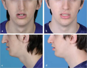 How to Get Rid of Mental Chin Crease Naturally | Mewing.coach