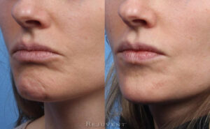 How to Get Rid of Mental Chin Crease Naturally | Mewing.coach