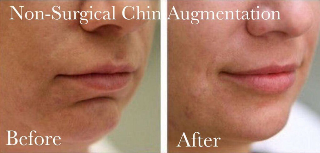 How to Get Rid of Mental Chin Crease Naturally | Mewing.coach