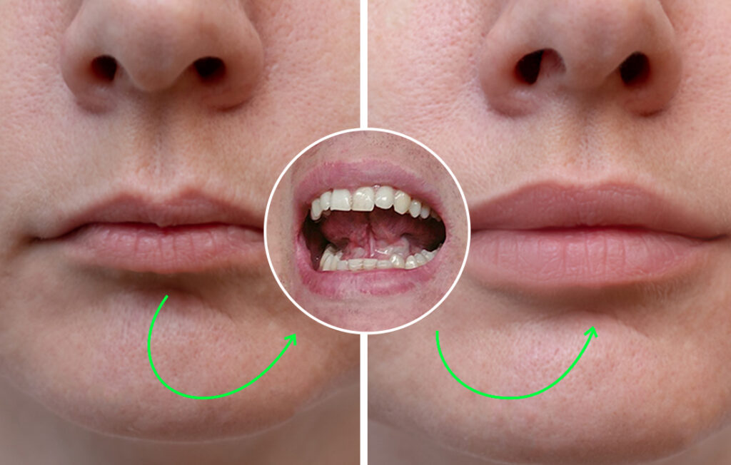 Mewing Guide: 8 Steps to Success (+How To Video & Diagram) | Mewing.coach