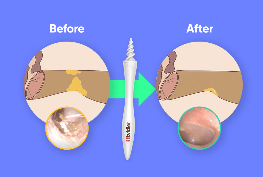 Can Impacted Earwax Cause Jaw Pain? | Mewing.coach