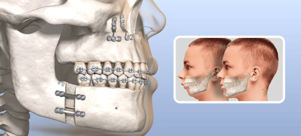Jawline Sculpting Made Simple: 16 Ways To Get Sculpted Jawline | Mewing ...