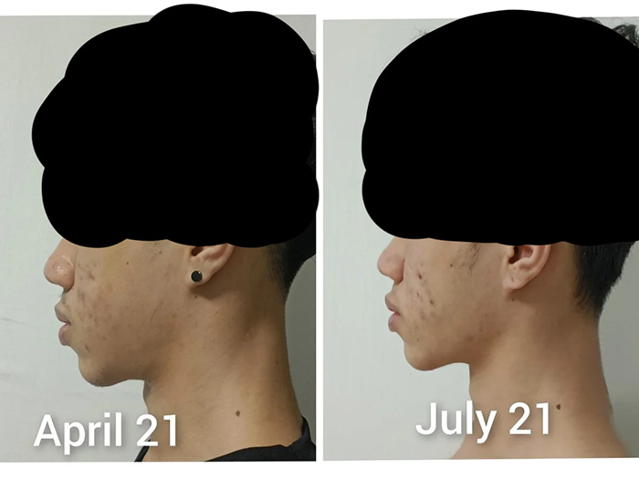 Mewing Before & After Results: 70+ Crazy Transformations