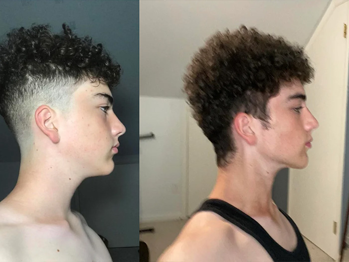 Mewing Before & After Results: 70+ Crazy Transformations