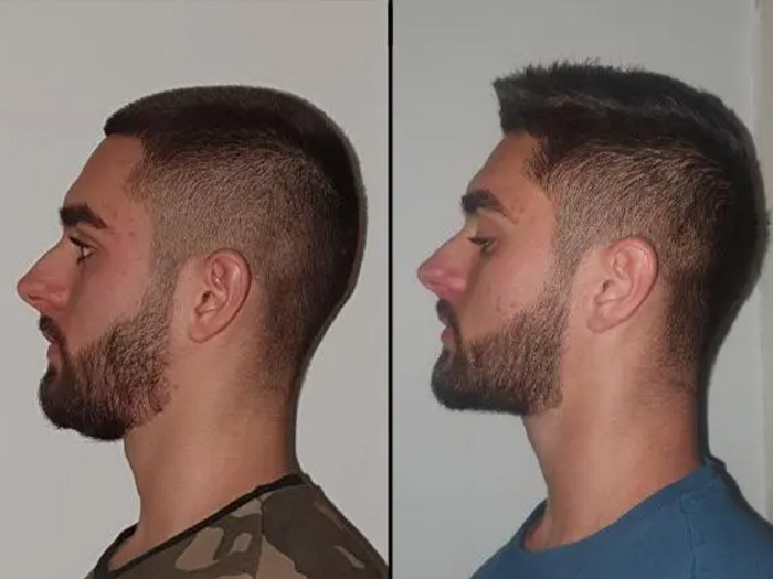 Mewing Before & After Results: 70+ Crazy Transformations