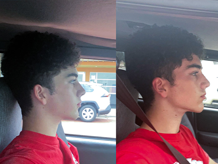 Mewing Before & After Results: 70+ Crazy Transformations