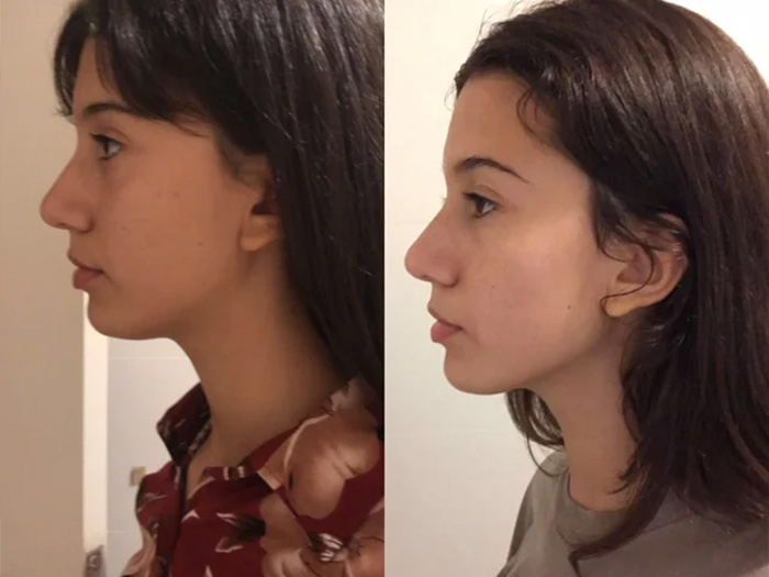 Mewing Before & After Results: 70+ Crazy Transformations