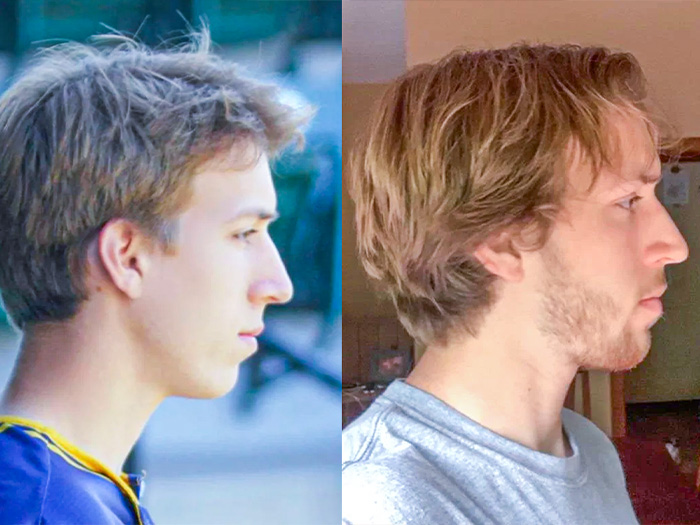 Mewing Before & After Results: 70+ Crazy Transformations