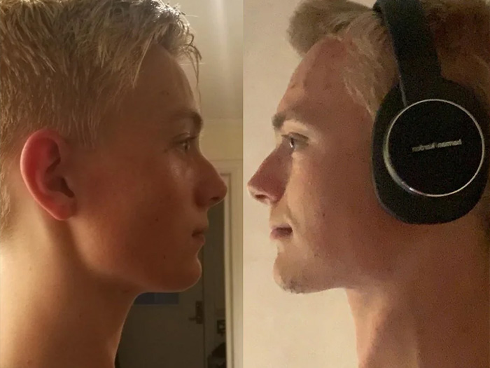 Mewing Before & After Results: 70+ Crazy Transformations