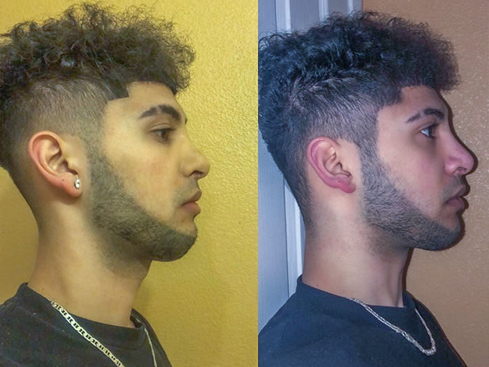 Mewing Before & After Results: 70+ Crazy Transformations